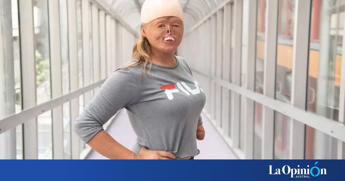 Tiene 21 años y a los 7 meses de haber nacido se quemó el cuerpo entero ...