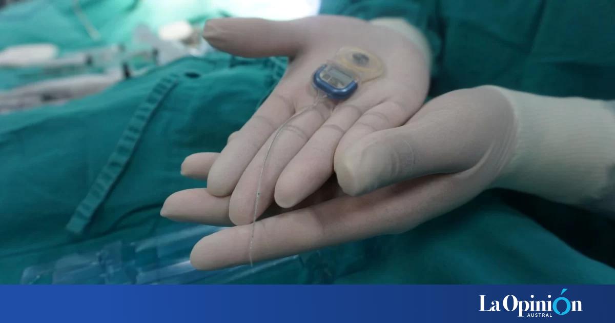 Se realizó la primera cirugía de implante coclear con un equipo de ...